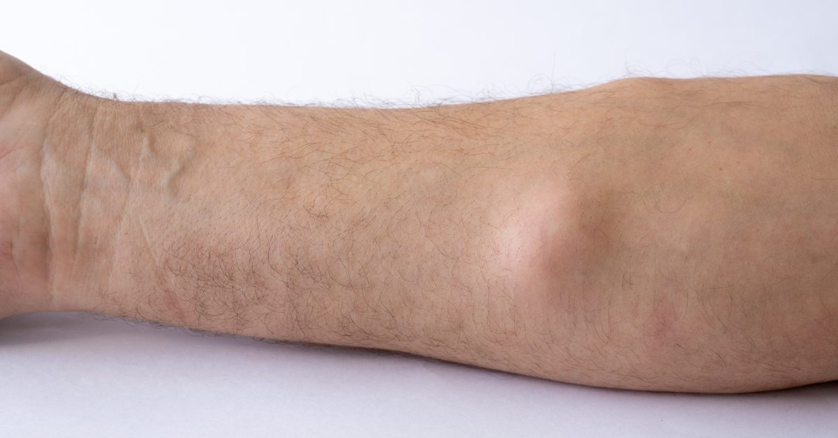 Lipoma: cos’è e come si cura