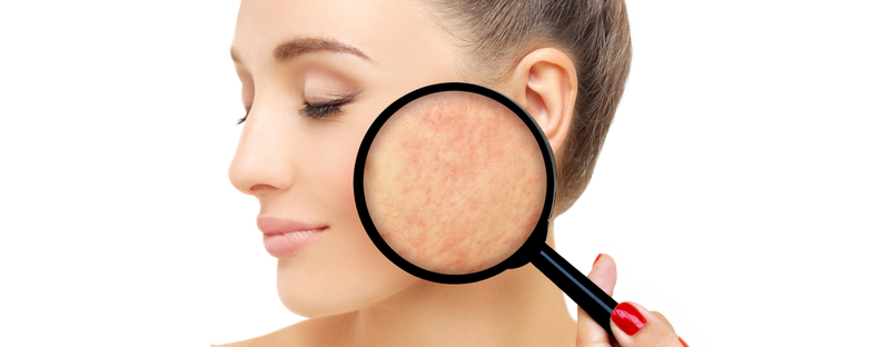 Macchie Solari: come si manifestano e rimedi per eliminarle