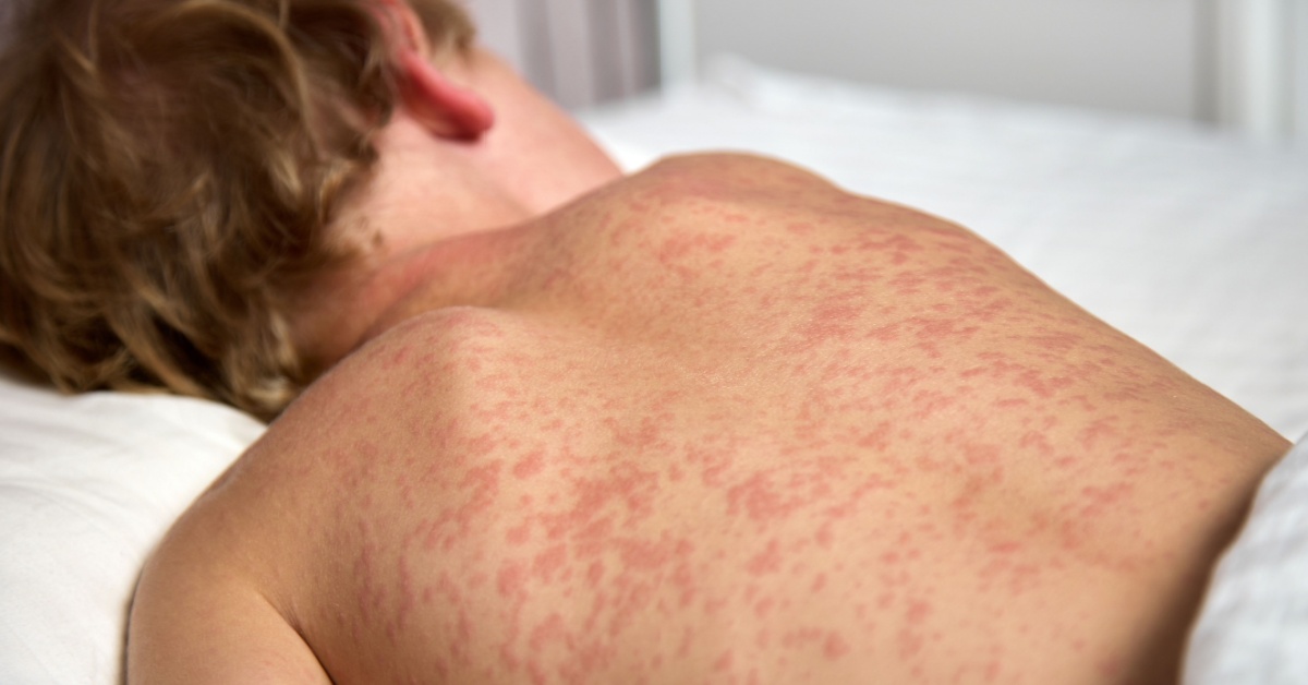 Morbillo: sintomi e cura in adulti e bambini